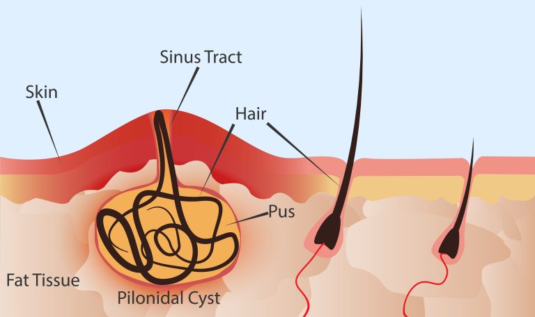 Pilonidal Cyst - BIOFLEX Laser Therapy Clinic